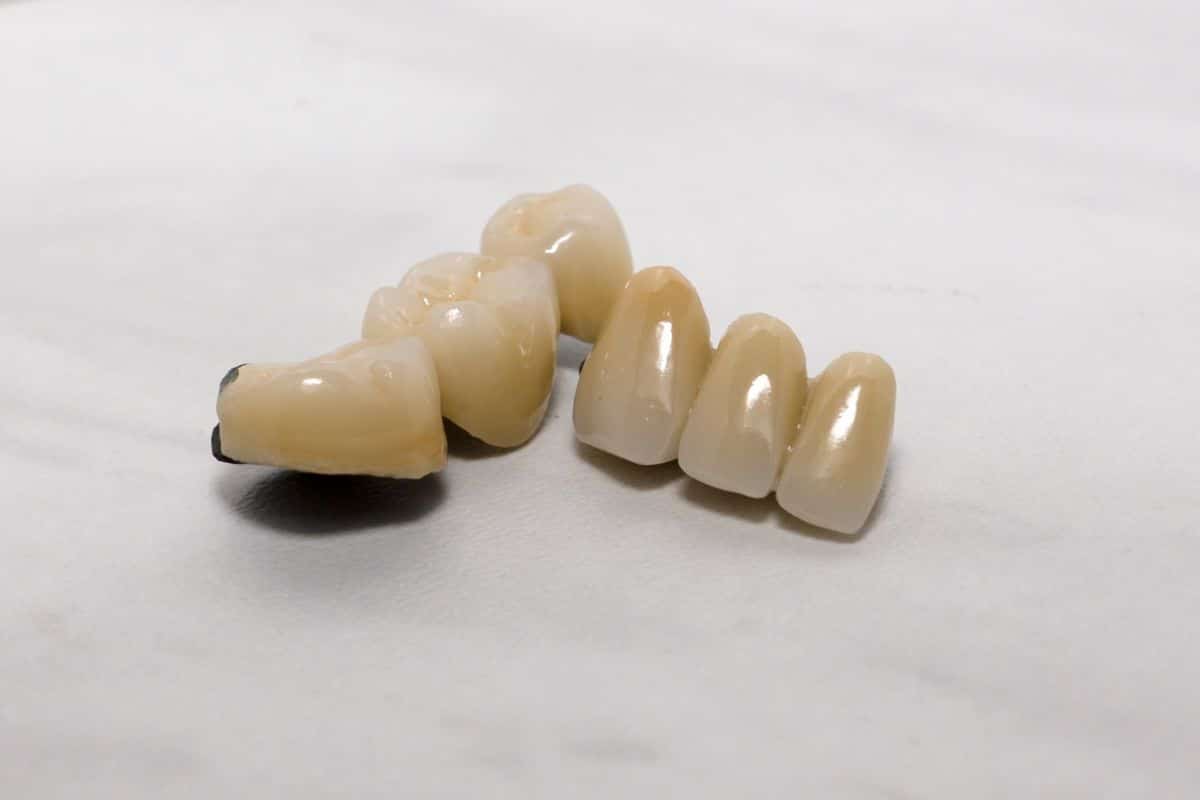 5 Reasons to Choose Same Day CEREC Crowns